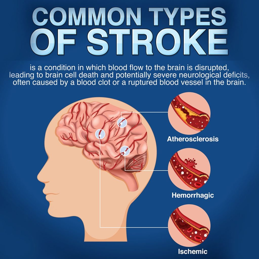 roke Stroke in India: A Present and Pressing Public Health Concern | by ...