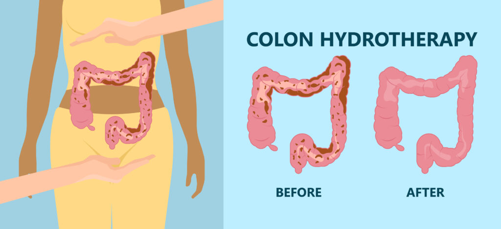 Colonic Hydrotherapy A Comprehensive Guide To Cleansing And Detoxification By Jackharry Medium