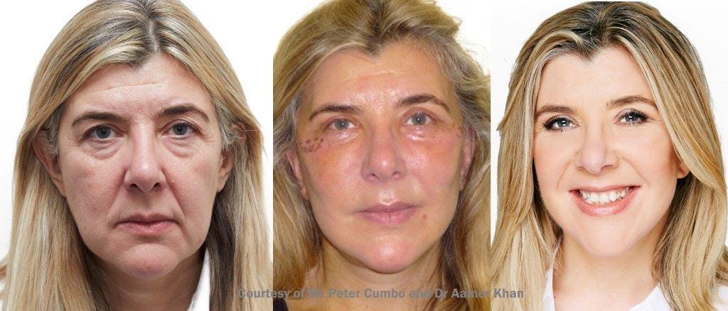 Cosmetic Surgery for Face Lift in London | by Harley Street Skin Clinic ...