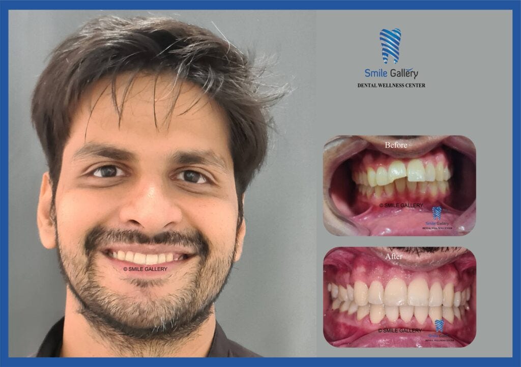 Braces Treatment in Bhopal | Smile-gallery.com - Smile Gallery Dental ...