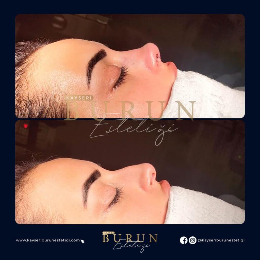 Sivas Burun Estetigi. Günümüzde estetik görünüm, insanların… | by Sivas burun estetigi | Aug ...