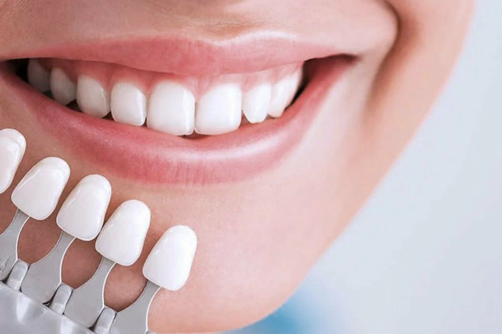 Rejuvenate Your Smile: Benefits of Dental Laminates for Aesthetic ...