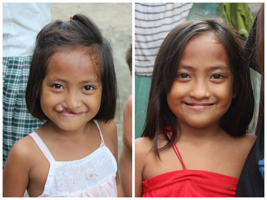 Smile Train Before And After