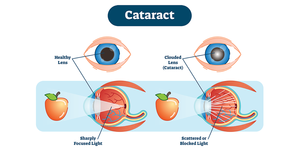 What Are Different Types Of Cataract Surgeries? | by Dr. Anisha Gupta ...