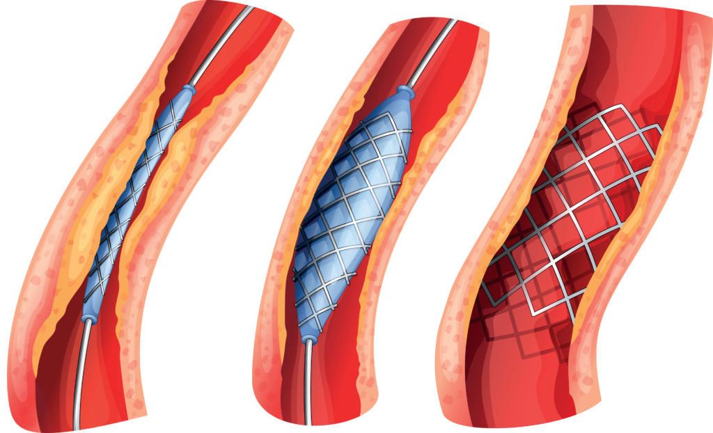 The Global Lung Stent Market Is Trending Towards Customized Stents | by ...