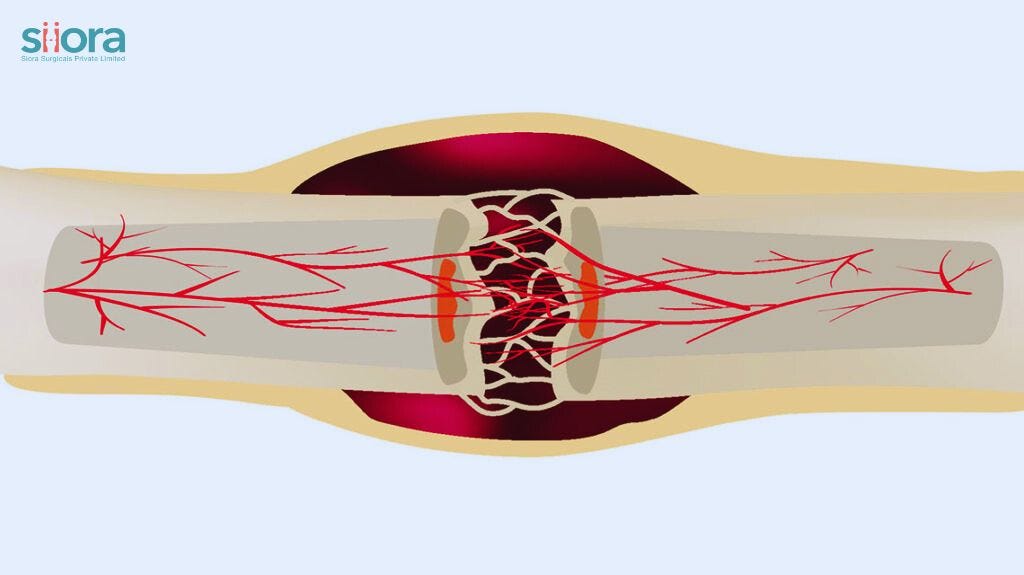 What Are the Signs of Bone Healing? - Siiora Surgical - Medium