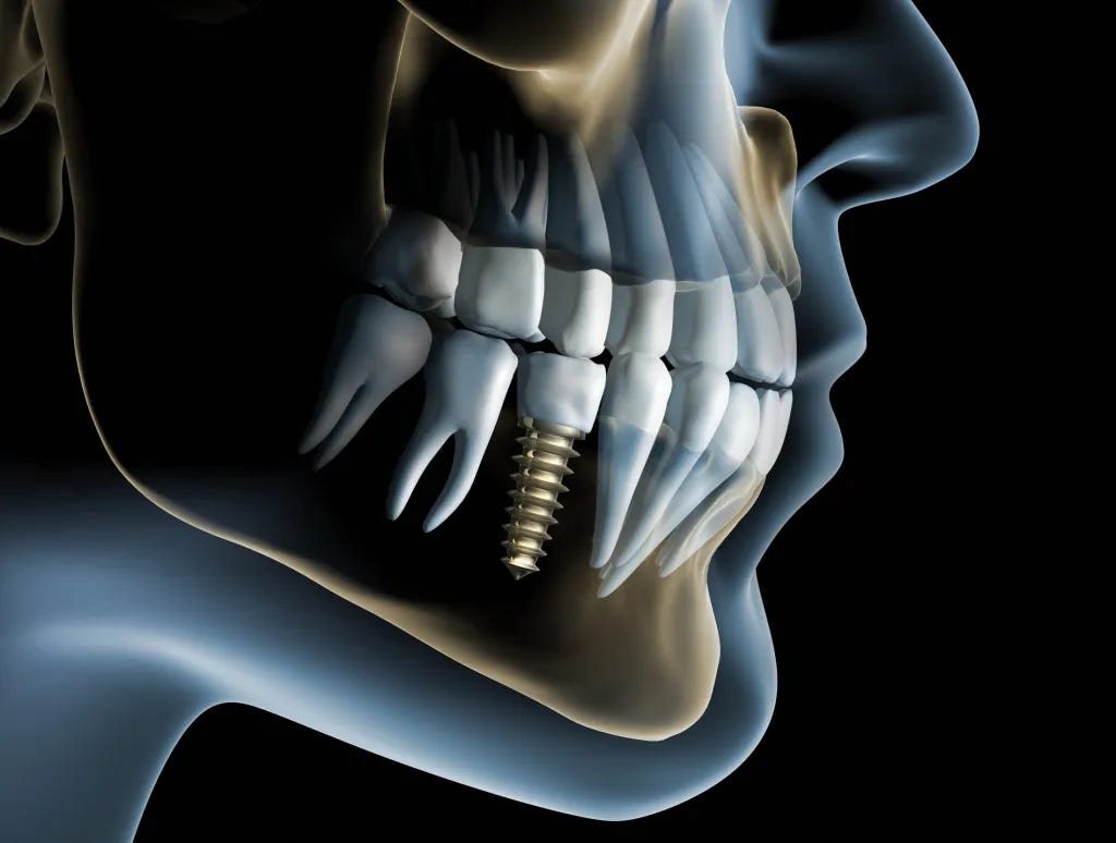 Implant Success and Longevity: Factors Influencing Surgical Outcomes ...