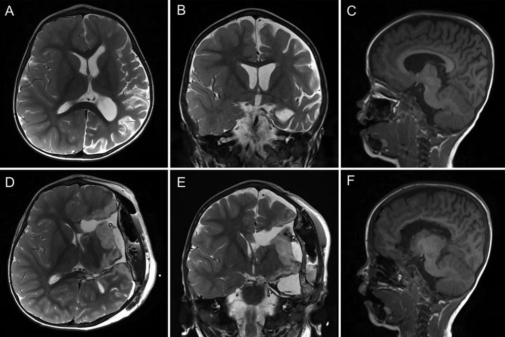 Paediatric Hemispherectomy. Hemispherectomies are performed in… | by ...