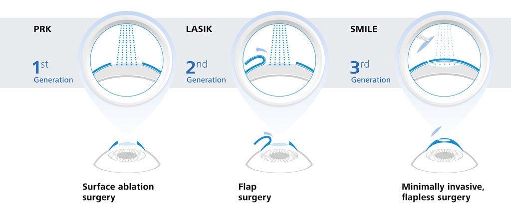 SMILE Eye Procedure: A Revolutionary Vision Correction Technique | by ...
