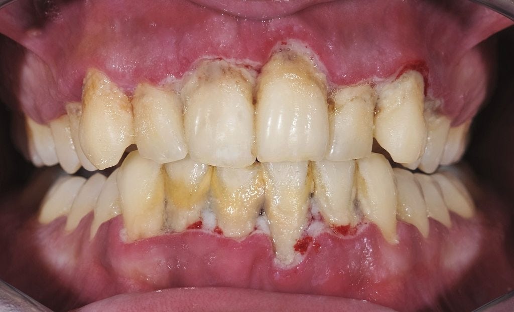 Chew THIS before bedtime — To Fix Tartar, Dental Plaque, Cavities ...