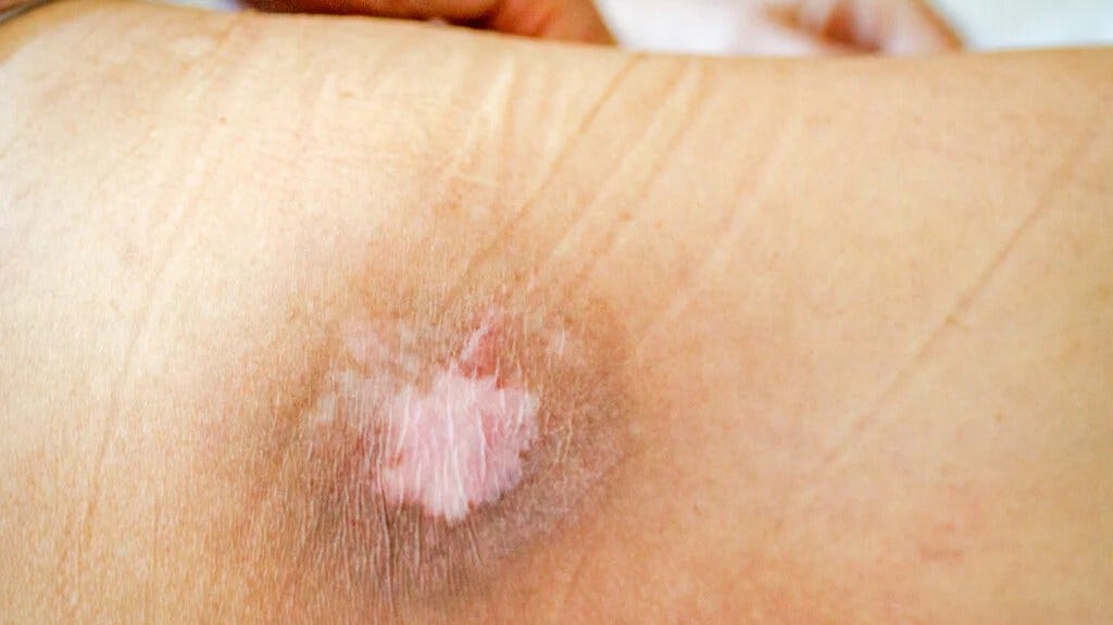 Bed sour. For bed sores (pressure ulcers)… | by ᴰʳ Adarsh Yadav 🇮🇳 ...