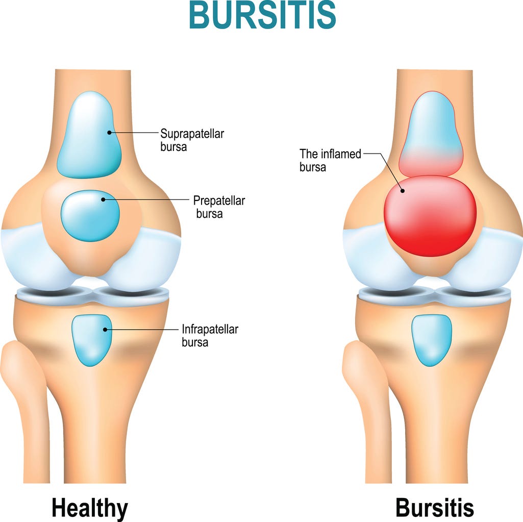 Treatment for Bursitis in Knee: Rapid Relief Tips | by Janetdavidson | Jul, 2024 | Medium