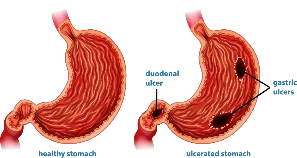 Gastric Ulcer Gastric Ulcer