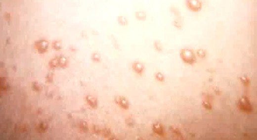 Hiv Blisters Arms
