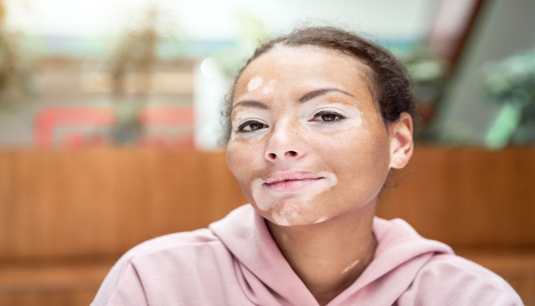 Skin Pigmentation. Do you often observe unusual dark spots… | by ...