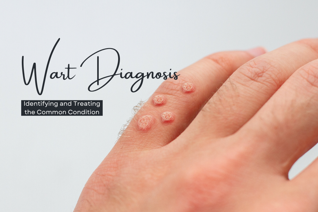 Wart Diagnosis: Identifying and Treating the Common Condition | by ...