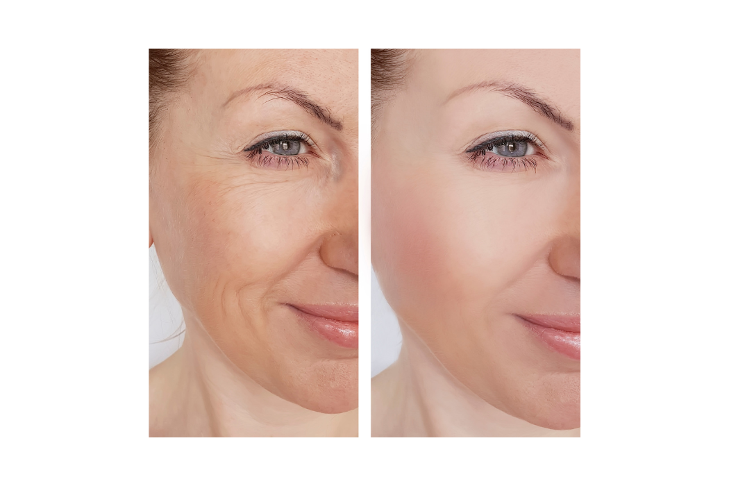 Achieve Smooth and Wrinkle-Free Skin with Dermal Fillers | by Jones ...