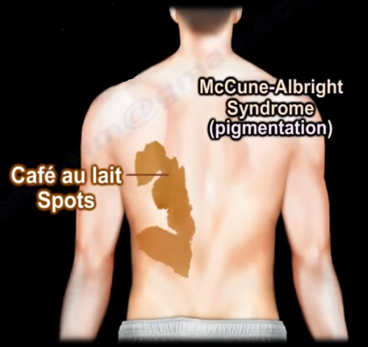 Cafe Au Lait Spots Mccune Albright Syndrome