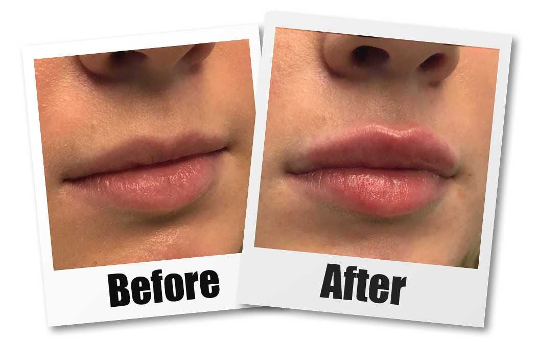 Lip Filler Cost Guide To Pricing And Financing Of Lip Augmentation