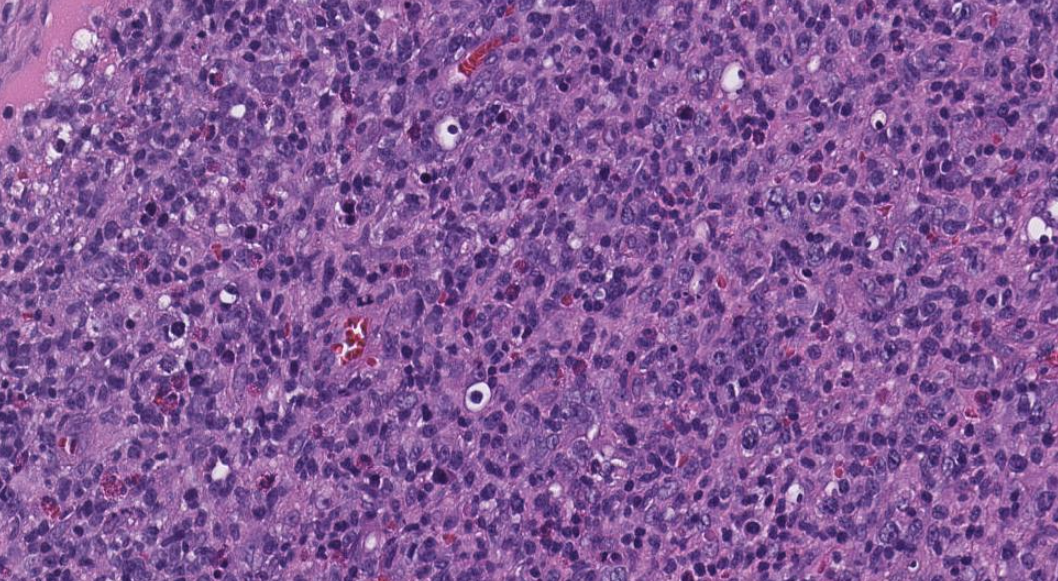 Lymphoma Cells In Suspension