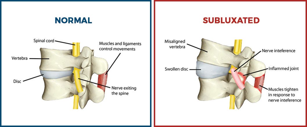 Understanding Subluxation. What is Subluxation? | by PraBill ...