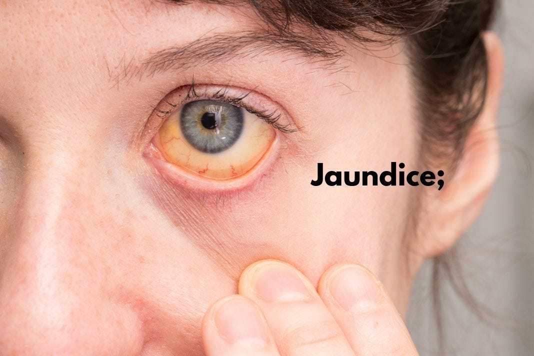 Cure Jaundice with Natural Remedies | by Emma Stone | Medium