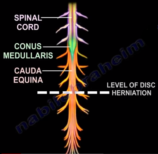 Where Does Cauda Equina Start