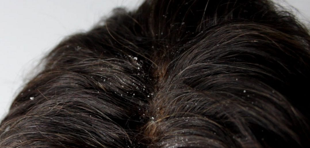 Top 5 Natural Remedies for Dandruff that gives Amazing Results | by ...