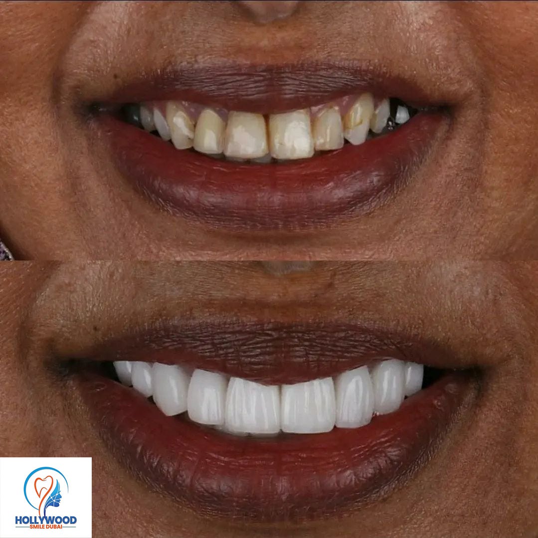 Best Hollywood Smile Clinic in Dubai - Hollywood Smile - Medium