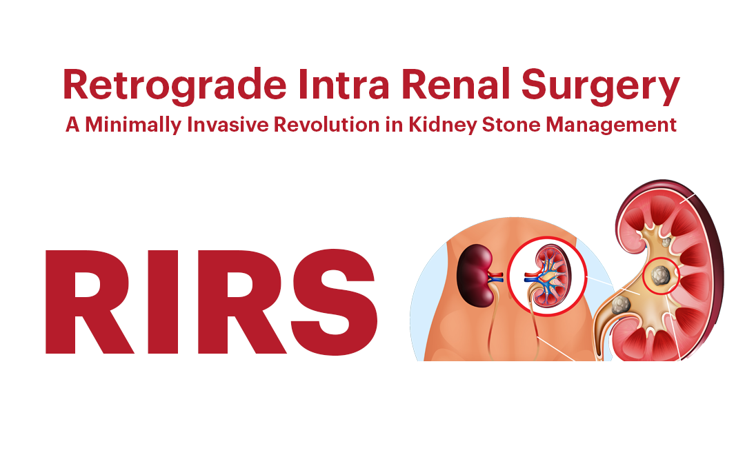 RIRS (Retrograde Intra Renal Surgery): A Minimally Invasive Revolution in Kidney Stone ...