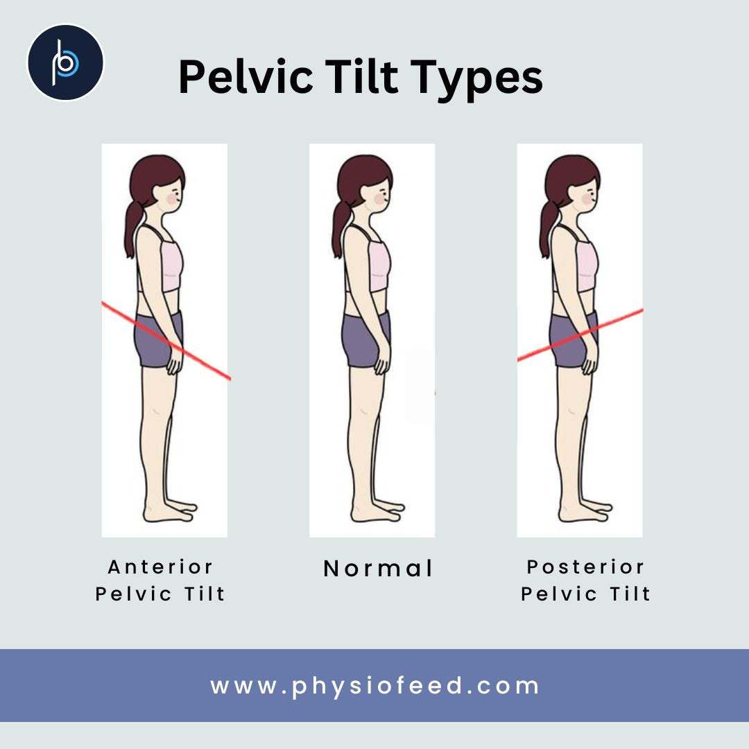 Pelvic Tilt Correction Through Physiotherapy | by Rimsha Manzoor | Oct, 2024 | Medium