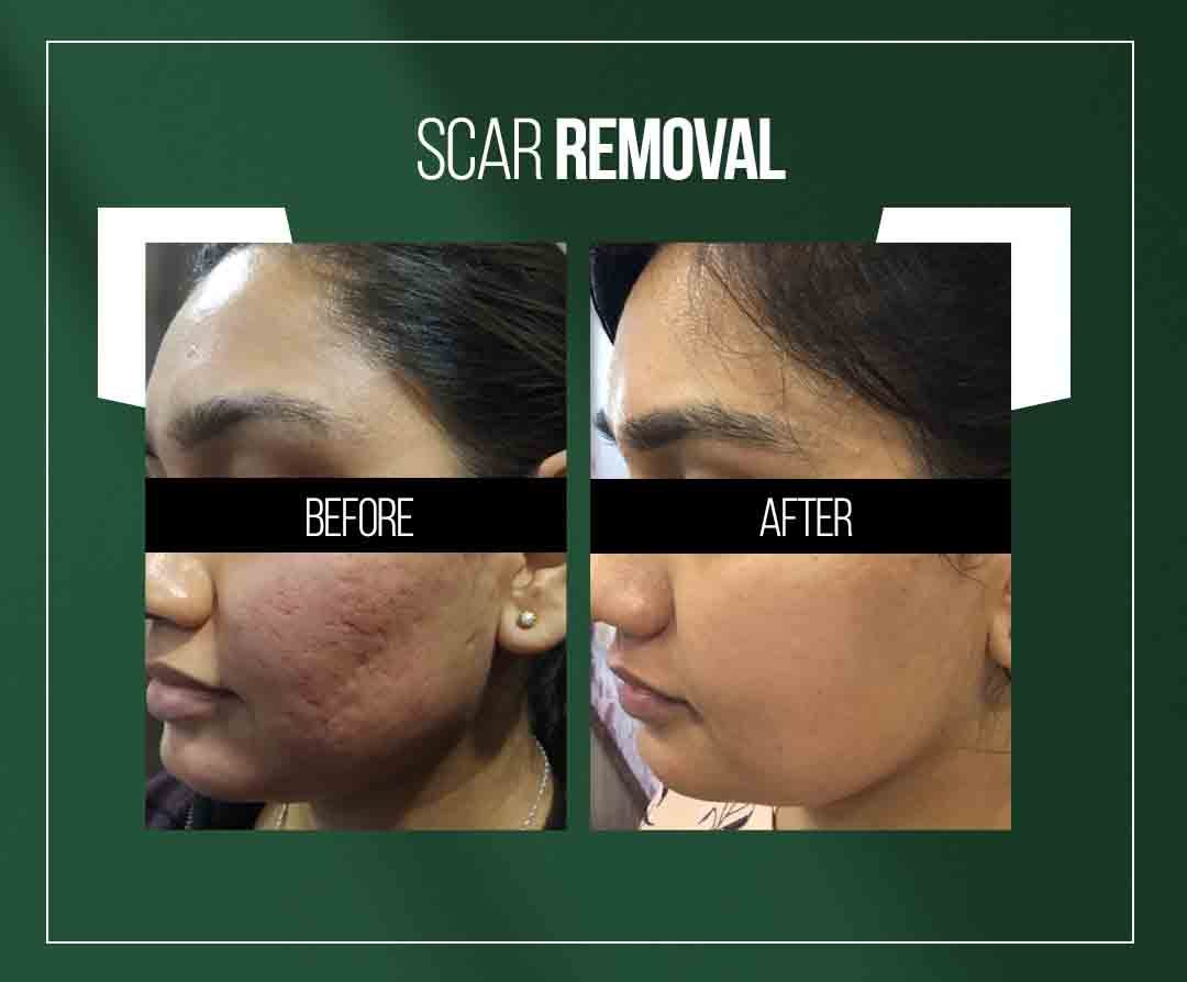 Radiant Skin: Best Acne Scar Treatment in Jaipur | by shivani | Jul ...