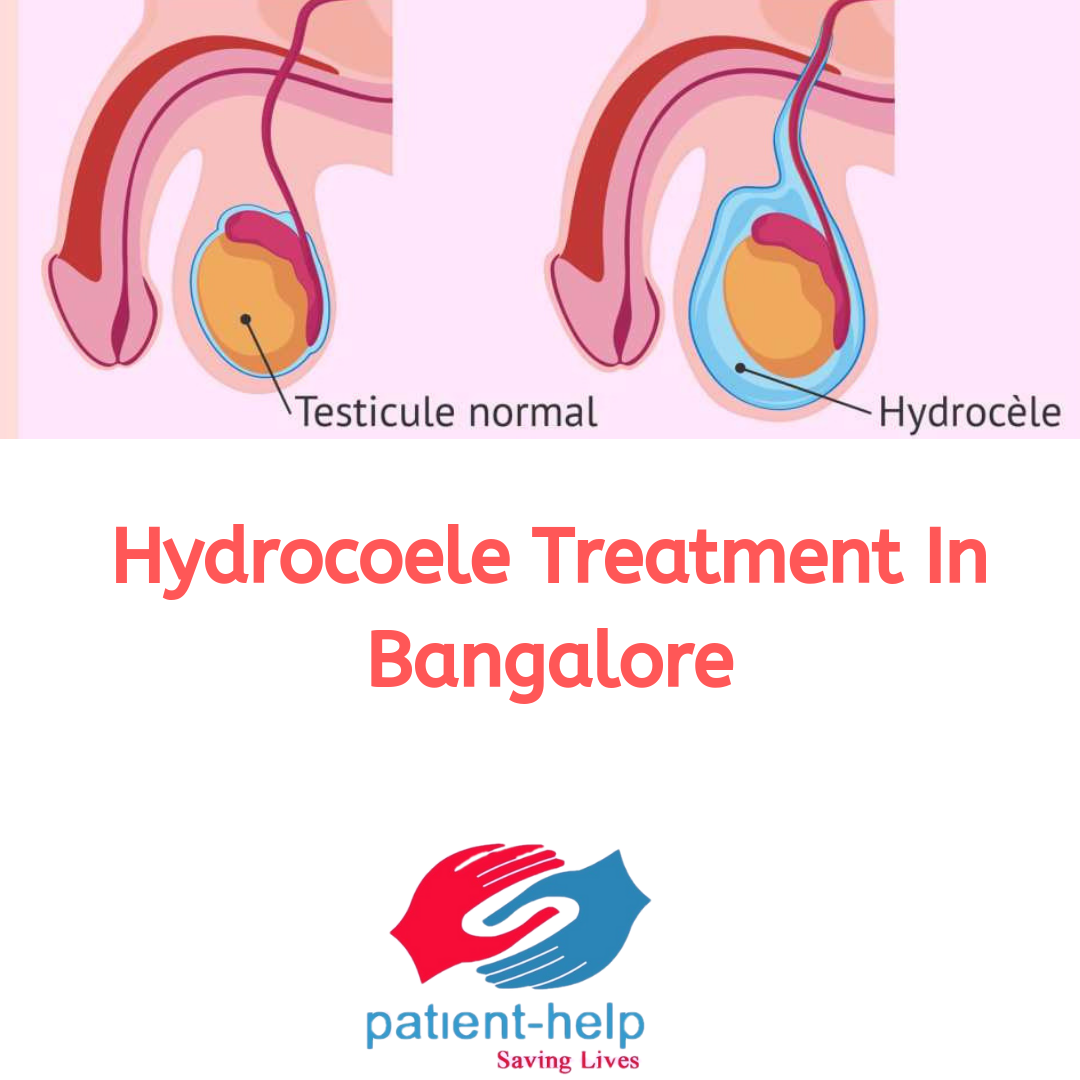 Hydrocoele Treatment In Bangalore | by Ravichandra B | Medium