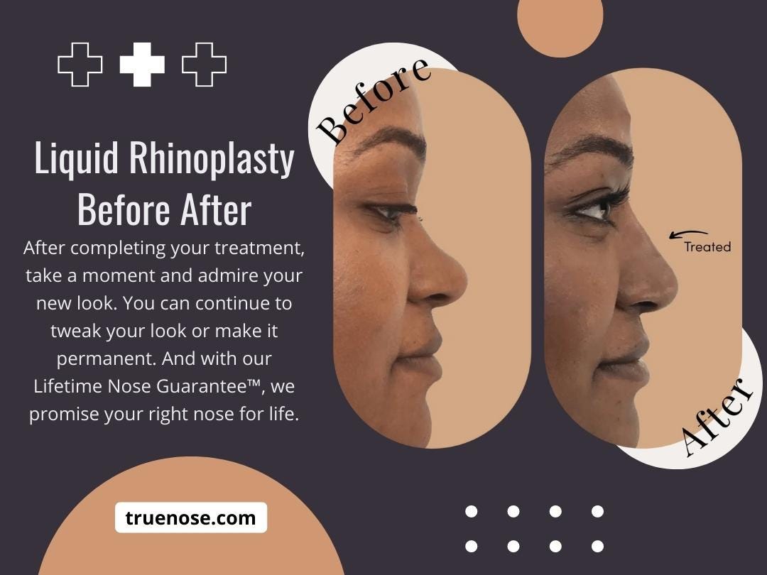 Liquid rhinoplasty before and after | by TrueNose | Medium
