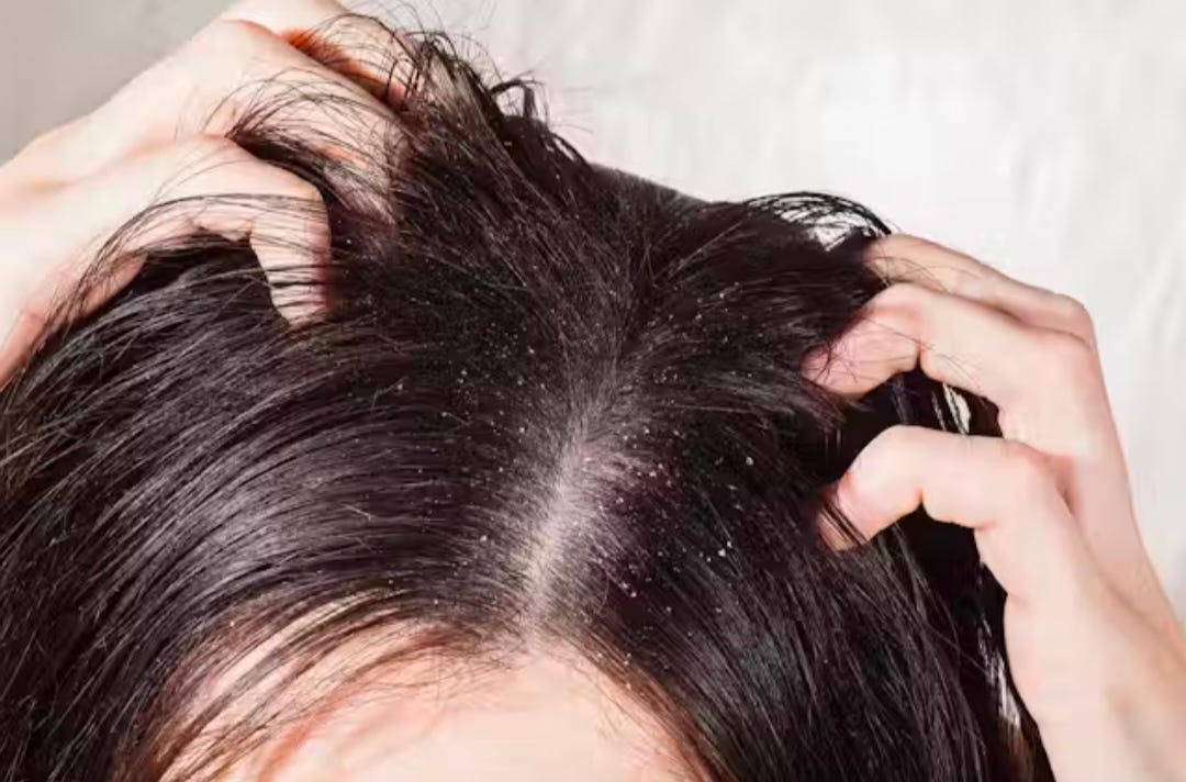 5 Home Remedies to Get Rid of Dandruff Naturally | by Herbal Life | Sep ...