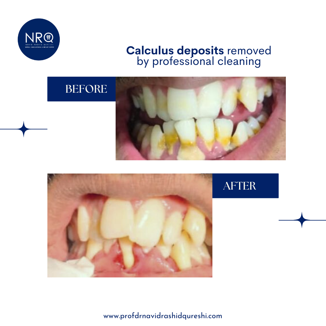 Calculus deposits lead to gum disease - Drprofnavidqureshi - Medium