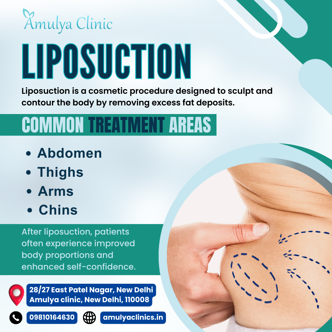 Comprehensive Guide to Liposuction — Best Cosmetic Surgery in Delhi ...