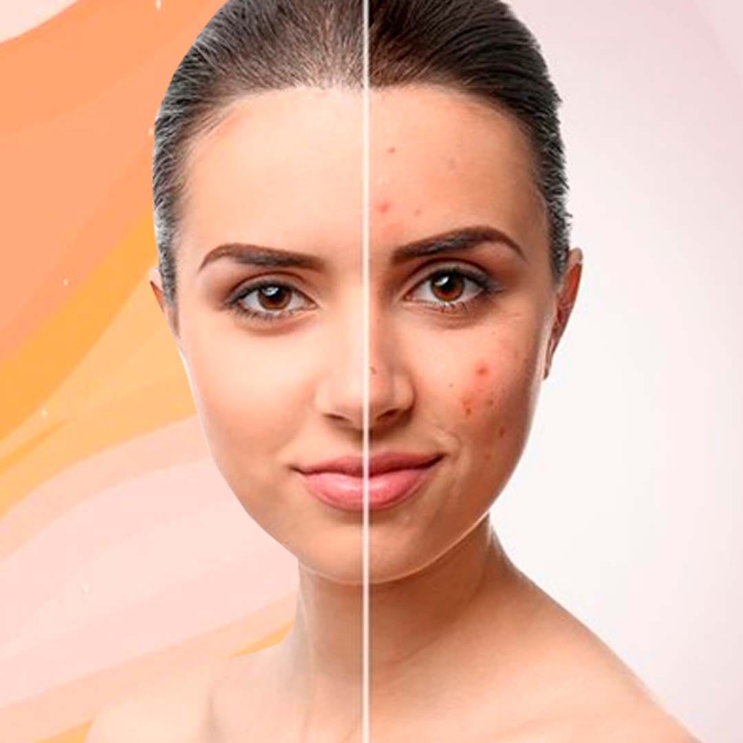 Mejores Cremas Para El Acné - Djifs - Medium