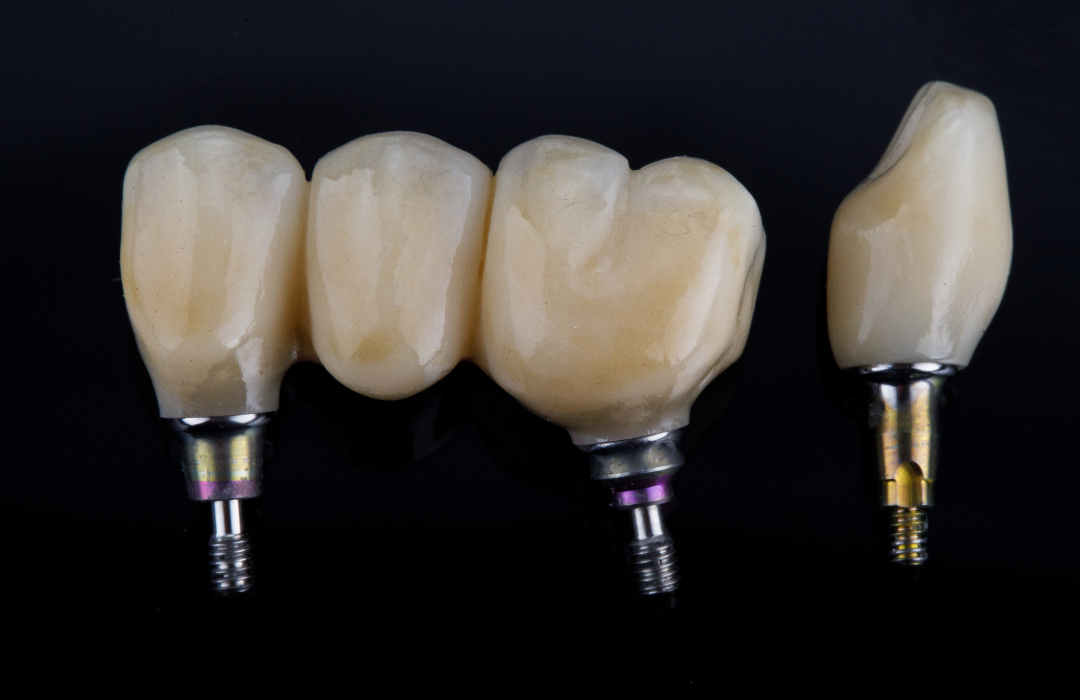 Dental Bridge vs. Partial Denture: Choosing the Right Option for Tooth ...
