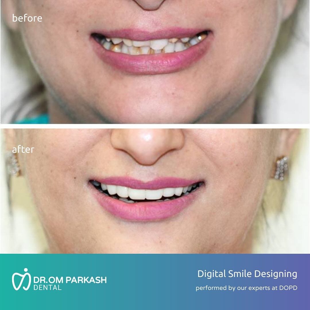Top Dentist Implant Specialist in Amritsar | Dr. OmParkash Dental - Dr. OmParkash Dental - Medium