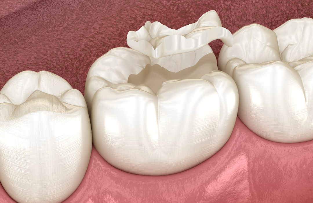 Composite Tooth-Colored Fillings: A Modern Solution for Dental ...