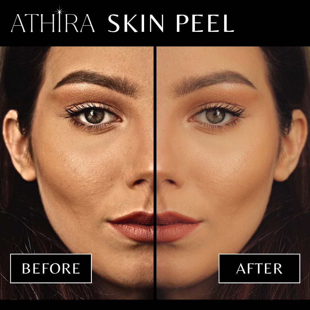 Microneedling And Chemical Peels: How Do They Work? | by ATHIRA SPA ...