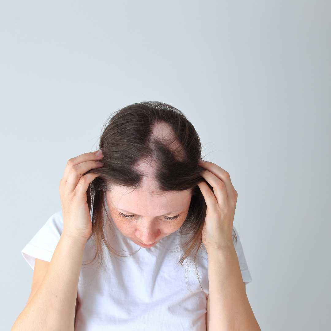 Baricitinb Shows Promise as a Treatment for Severe Alopecia Areata (Hair Loss) | by Teja V ...