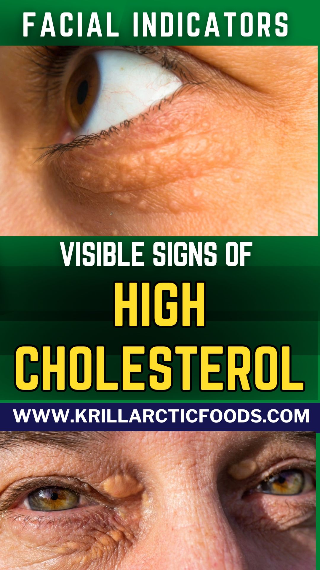 Are there any visible signs on face of high cholesterol? - Krill Arctic ...