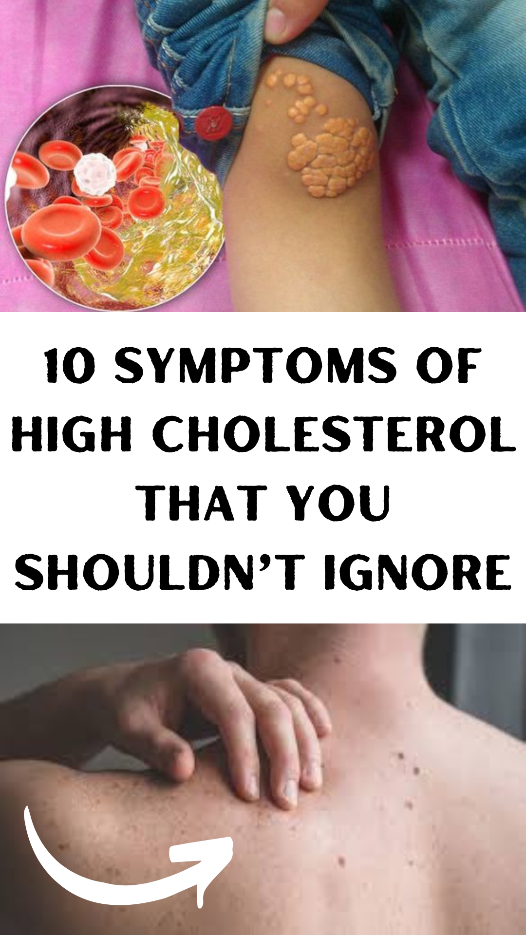 10 Symptoms Of High Cholesterol That You Shouldn’t Ignore - Olivia ...