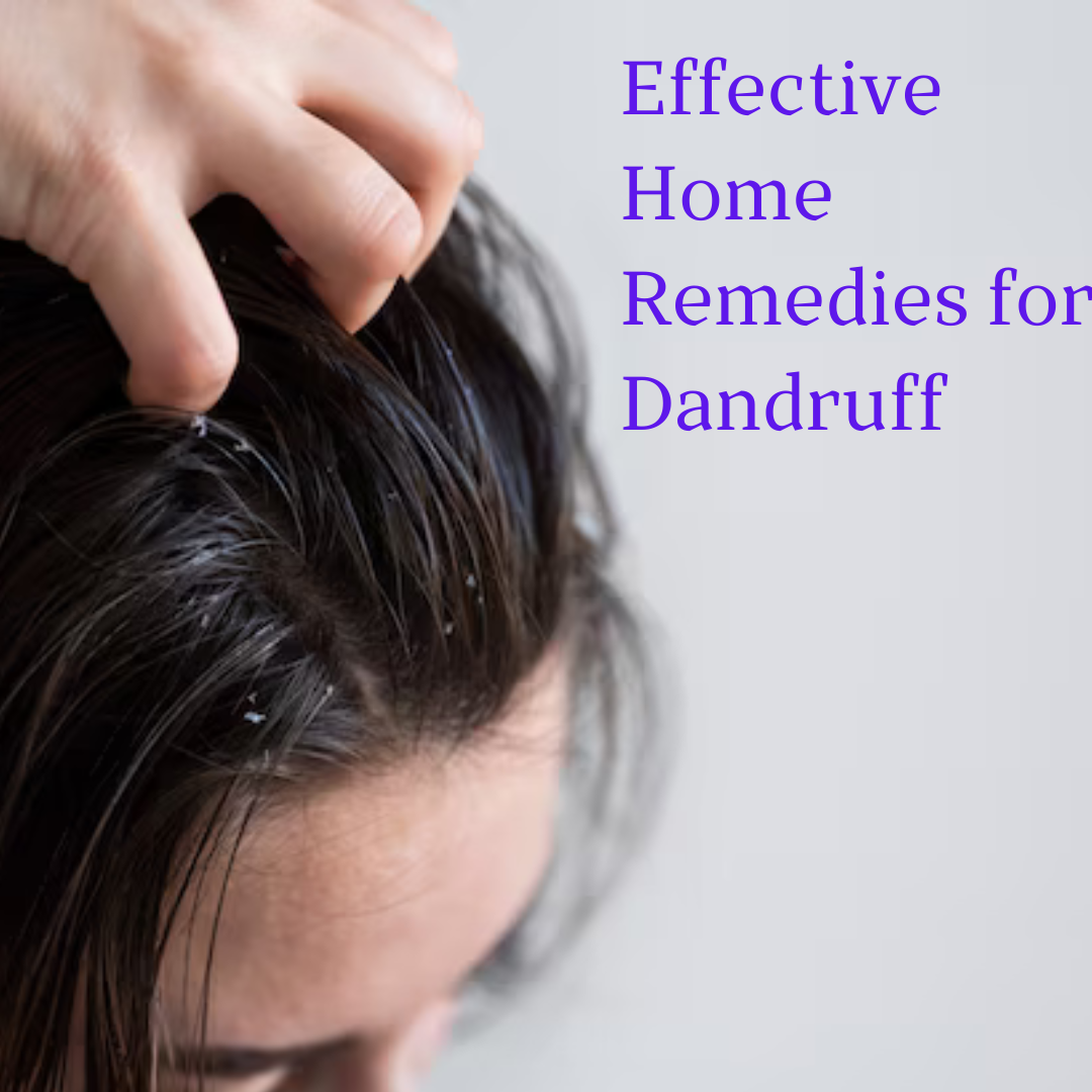 Effective Home Remedies for Dandruff | by Fazlullahsadiq | Aug, 2024 ...