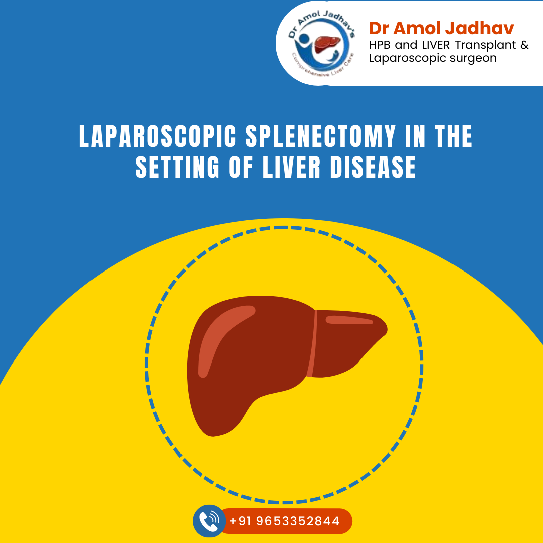 Laparoscopic Splenectomy | Dr. Amol Jadhav | Best Liver Surgeon in Pune ...