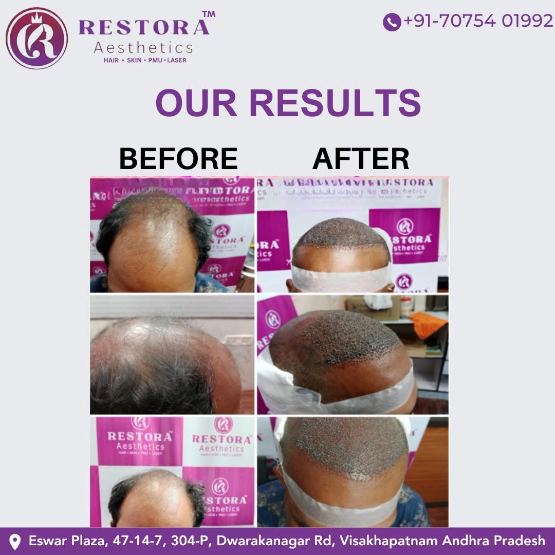 Best Hair Transplant in Vizag - Restora Aesthetics - Medium