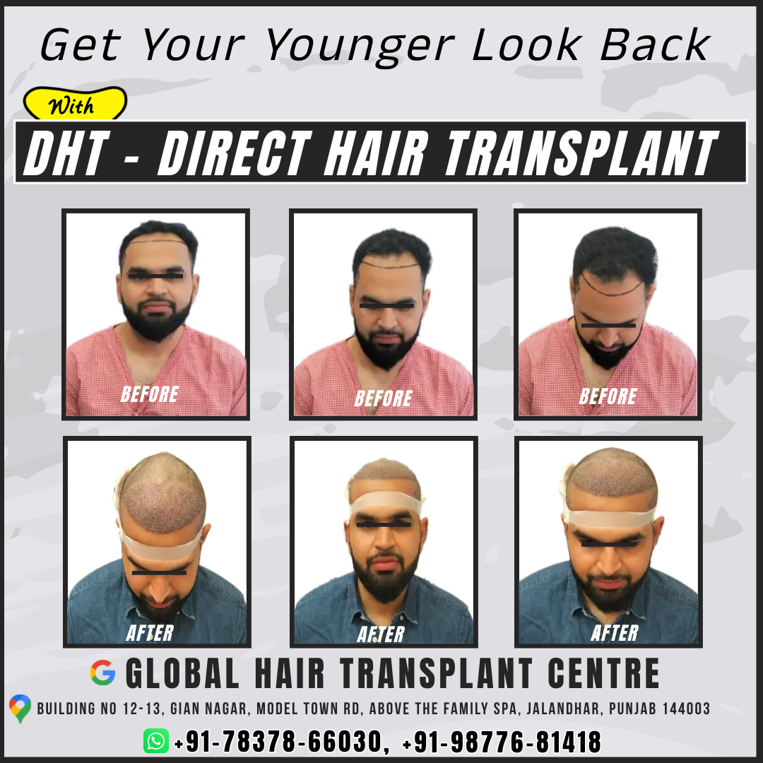 Hair Transplant In Jalandhar at Global Hair Transplant ...