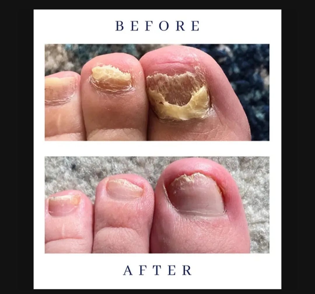 REAL cause of Toenail fungus revealed and How to Eliminate it in less ...